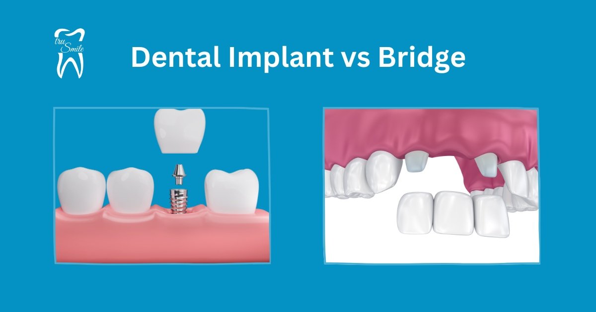 Dental Implant vs Bridge: Which Option is Better?